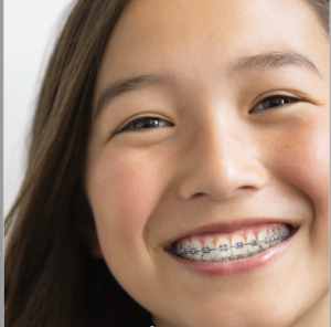 Orthodontist Orange County, CA | Braces